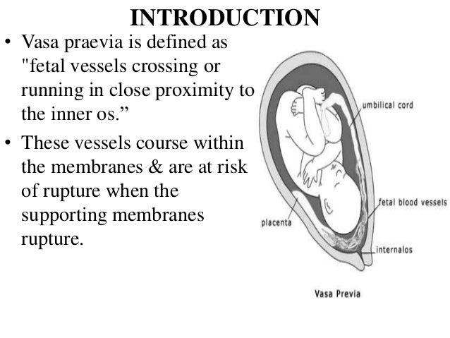 Cord pn+vasa praevia+afe