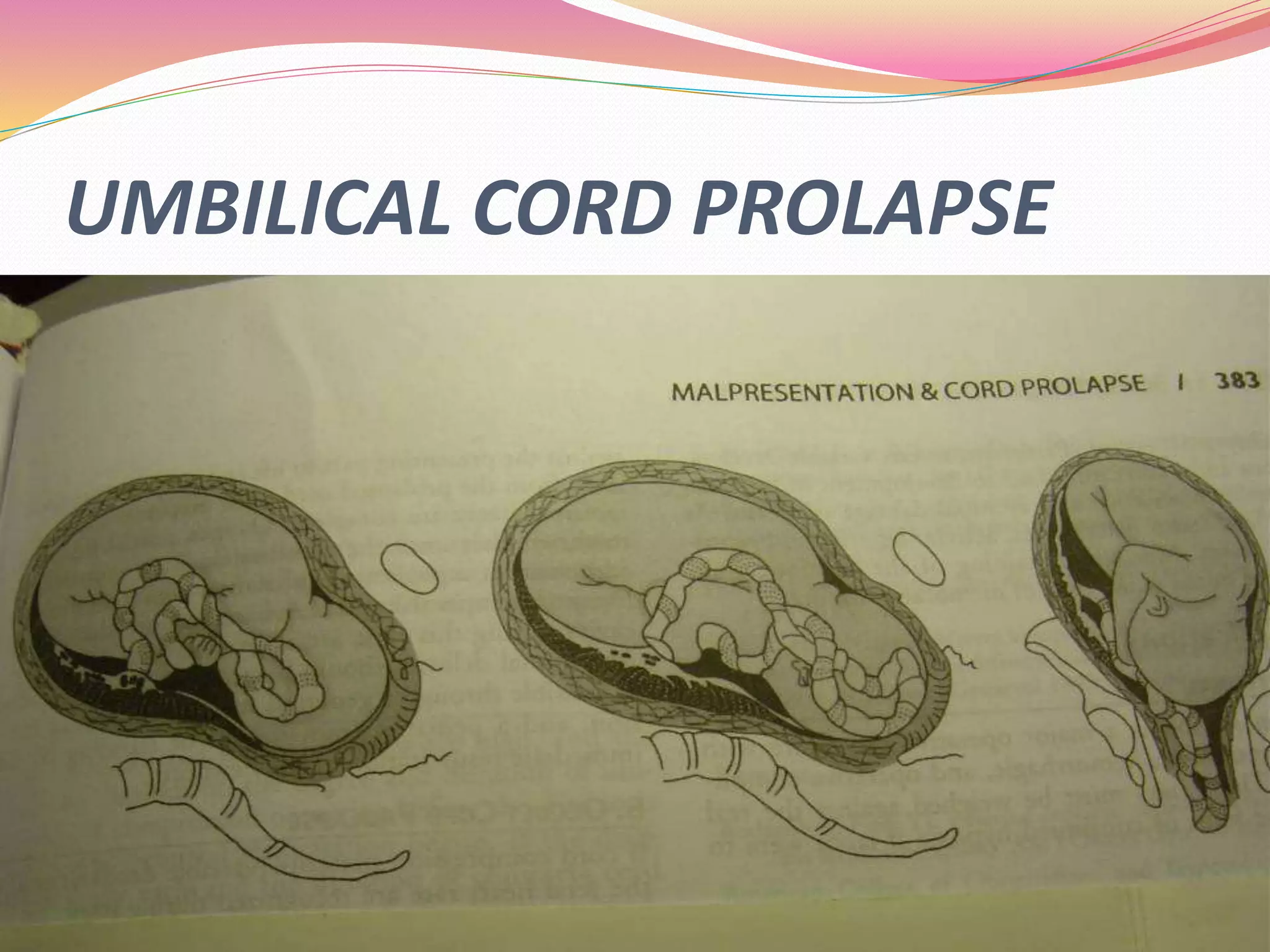 Umbilical Cord prolapse | PPTX