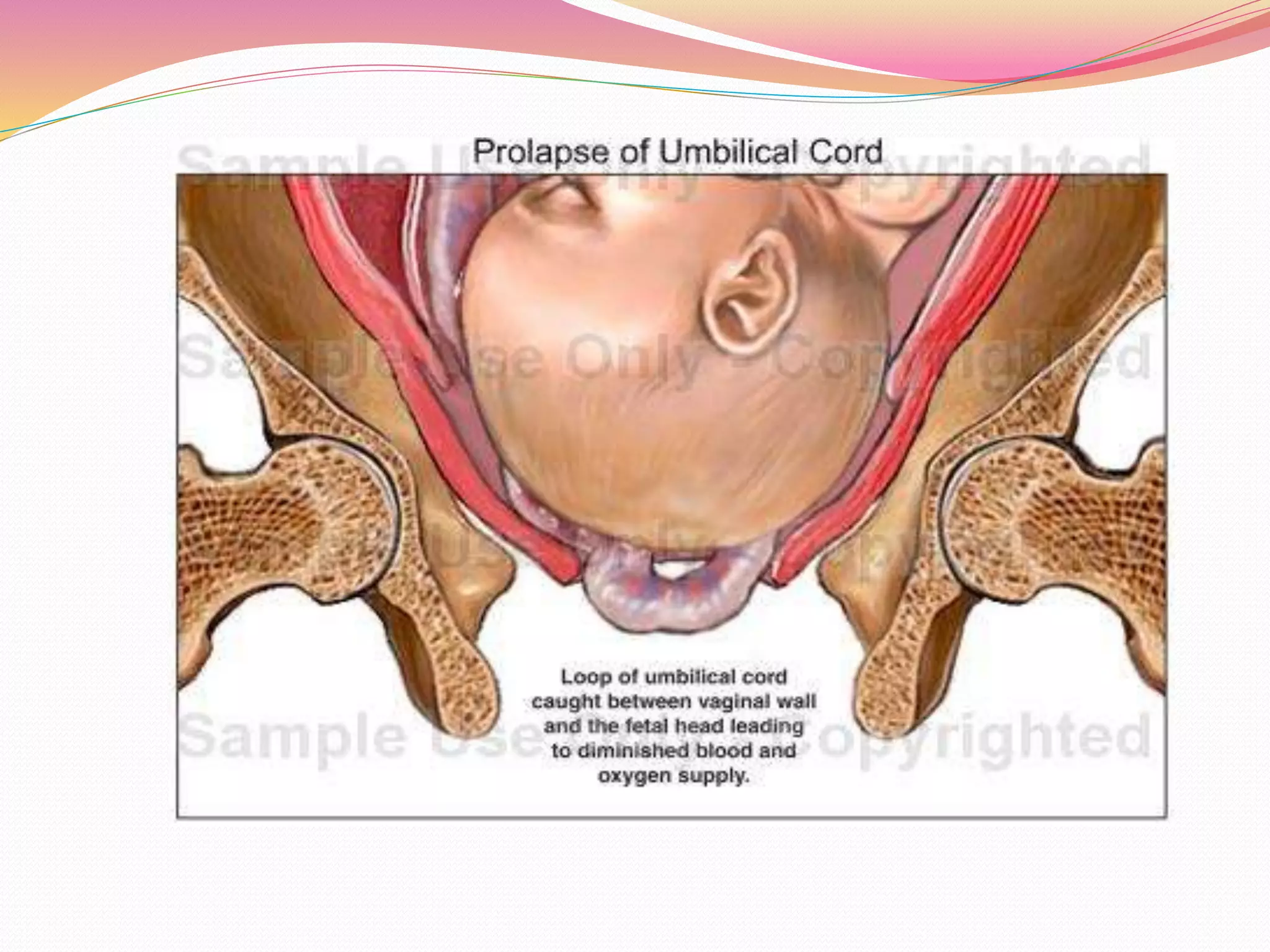 Umbilical Cord prolapse | PPTX