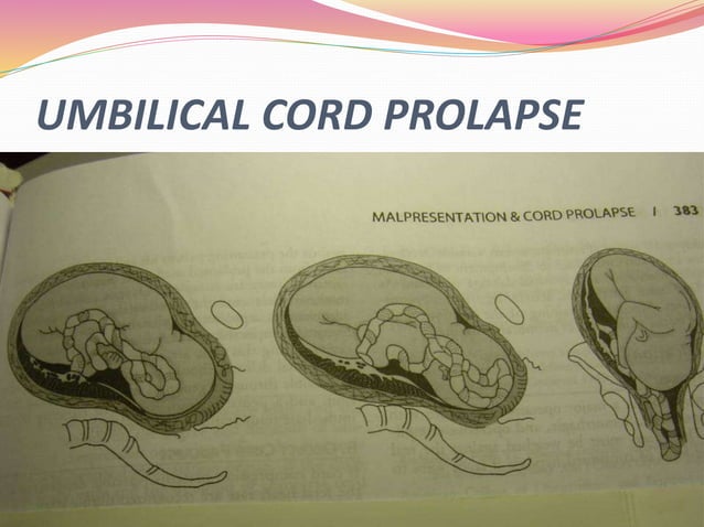 Umbilical Cord prolapse | PPT