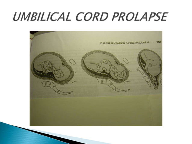 Cord prolapse | PPT