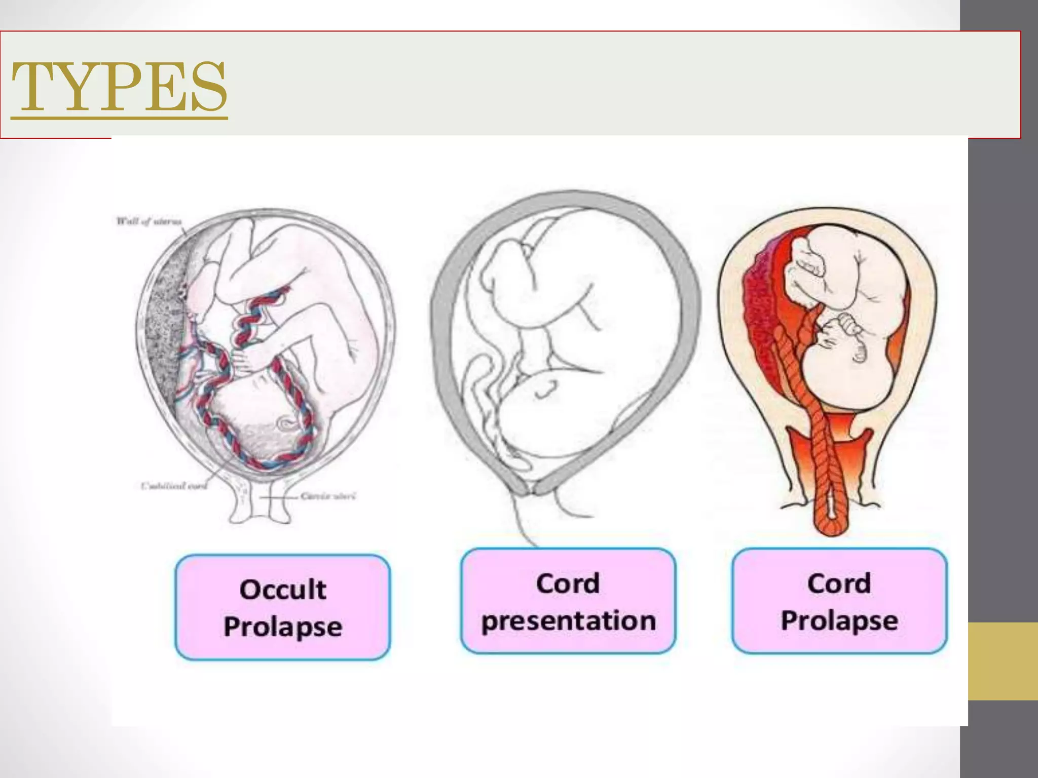 Umbilical Cord prolapse | PPTX