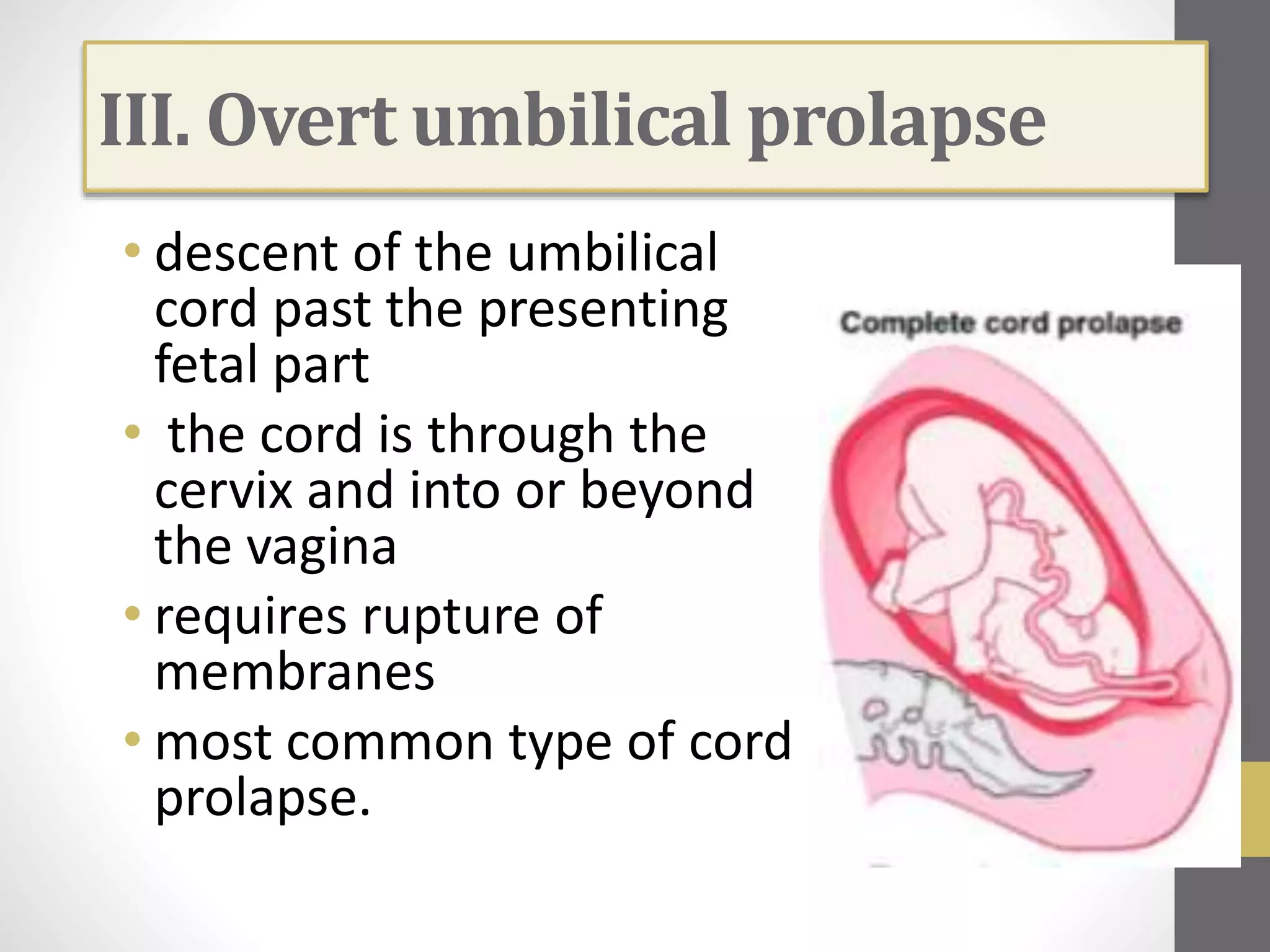 Umbilical Cord prolapse | PPTX