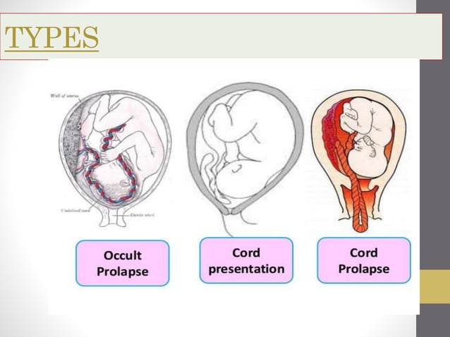 Umbilical Cord prolapse | PPTX | Pregnancy | Reproductive Health