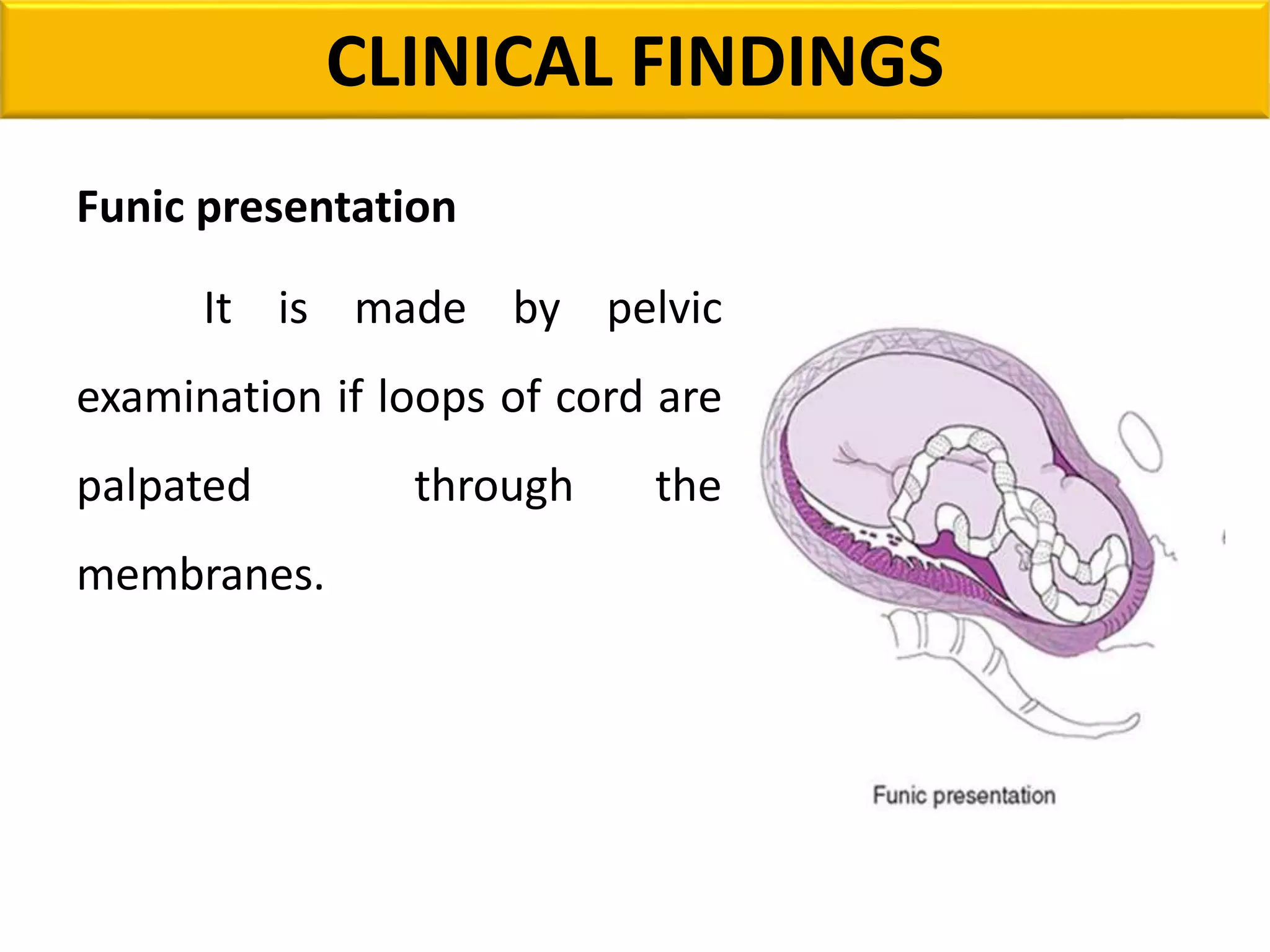 CORD PROLAPSE | PPTX