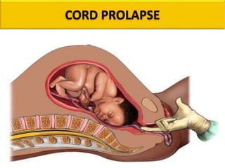 Prolapsed Cord