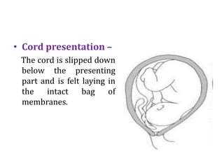 Cord Prolapse.pptx