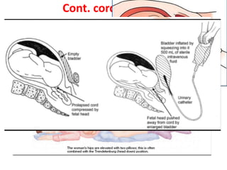 a very helpful quide to cord prolapse.pptx