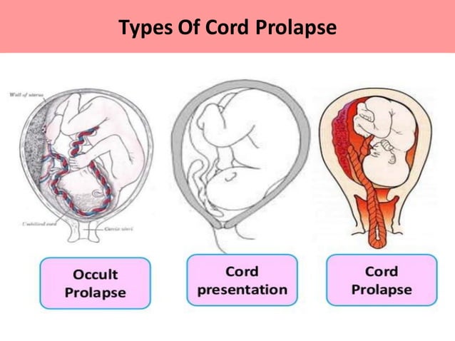 cord prolapse 1.pdf | Pregnancy | Reproductive Health