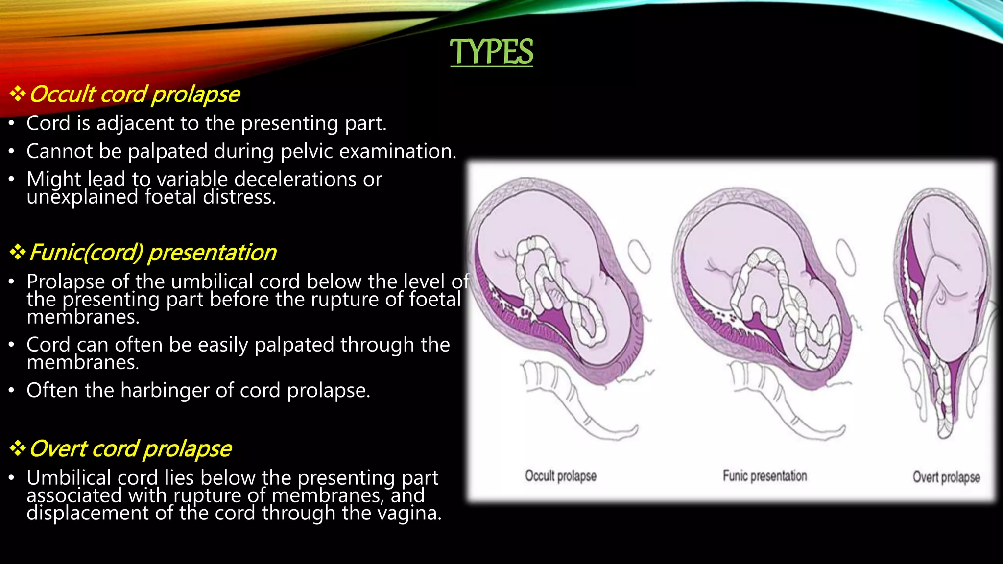 CORD PROLAPSE AND CORD PRESENTATION.pptx