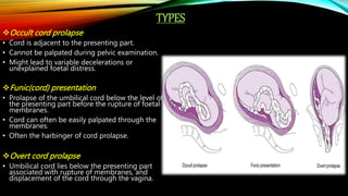 CORD PROLAPSE AND CORD PRESENTATION.pptx