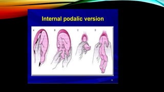 CORD PROLAPSE AND CORD PRESENTATION (1).pptx