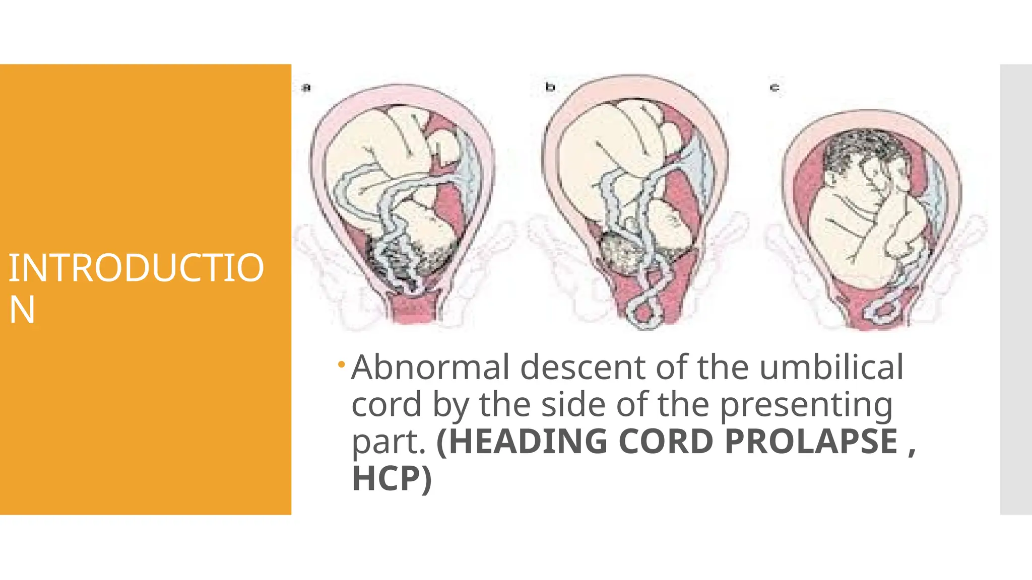 cord prolapse and presentation BY ANUSHRI SRIVASTAVA.pptx