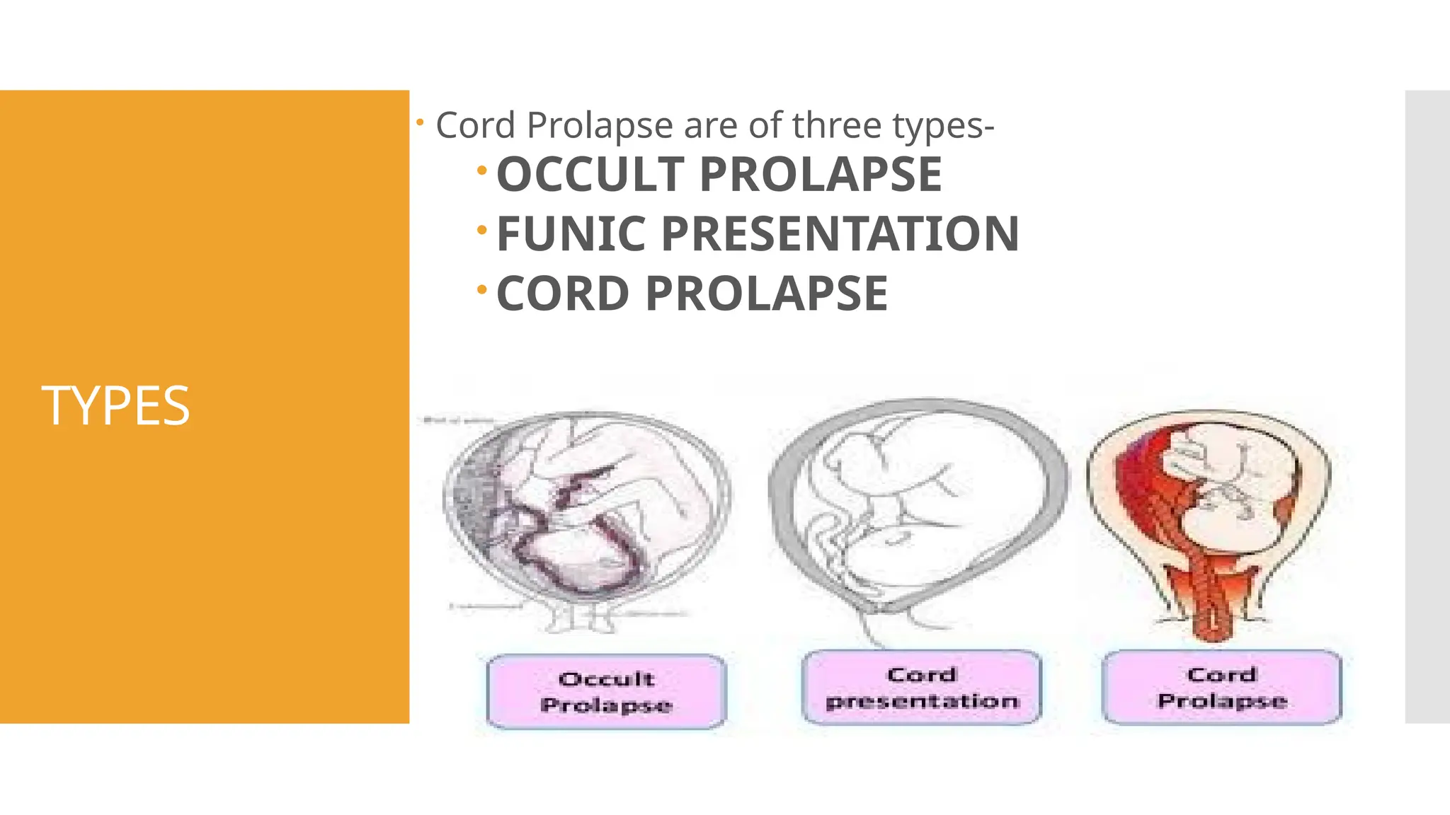 cord prolapse and presentation BY ANUSHRI SRIVASTAVA.pptx