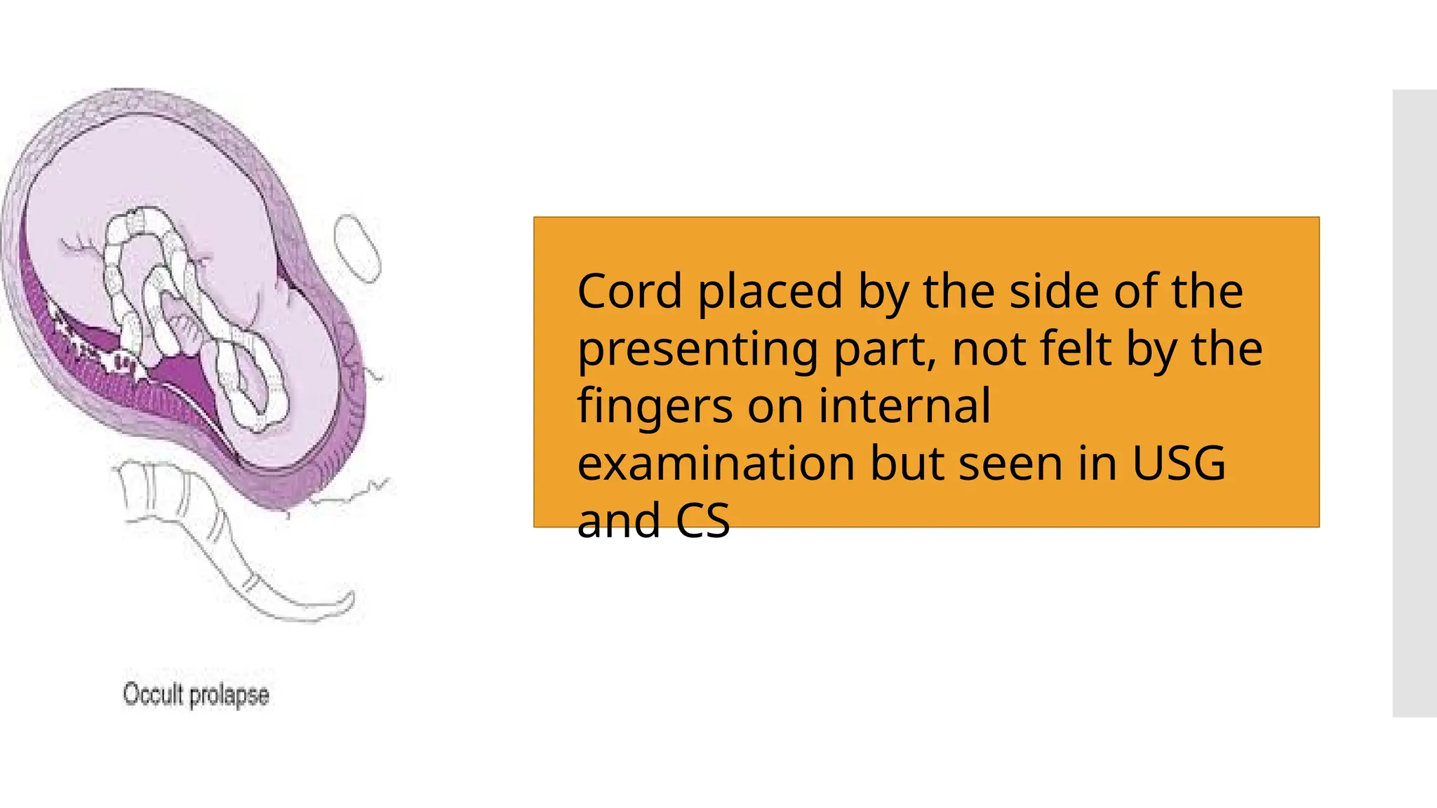 cord prolapse and presentation BY ANUSHRI SRIVASTAVA.pptx
