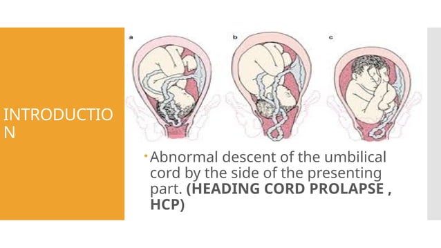 cord prolapse and presentation BY ANUSHRI SRIVASTAVA.pptx