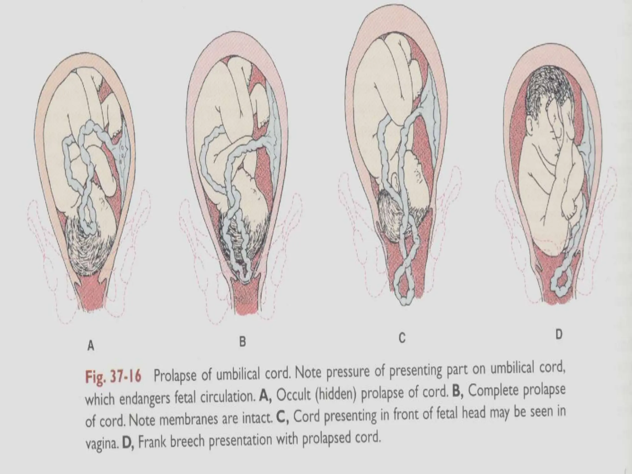 CORD PROLAPSE CORD PRESENTATION (1).pptx