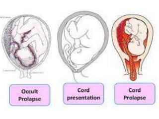 CORD PROLAPSE CORD PRESENTATION (1).pptx