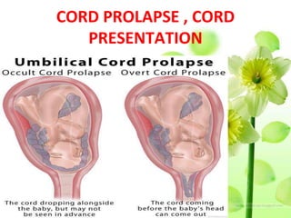 CORD PROLAPSE CORD PRESENTATION (1).pptx