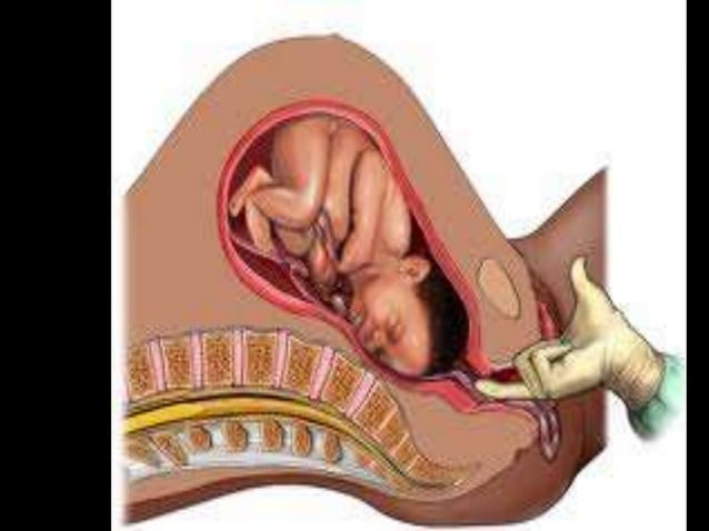 CORD PROLAPSE CORD PRESENTATION (1).pptx