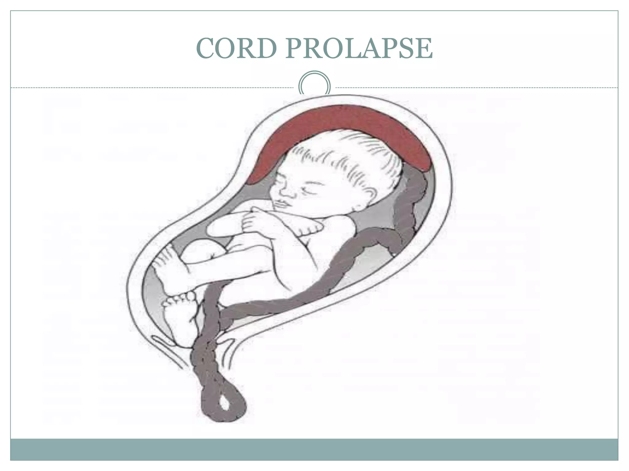Cord prolapse & cord presentation | PPTX