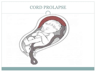 Cord prolapse & cord presentation | PPTX