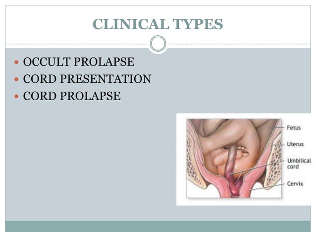 Cord prolapse & cord presentation | PPTX | Pregnancy | Reproductive Health