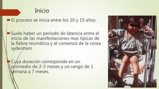 Corea Fiebre Reumática