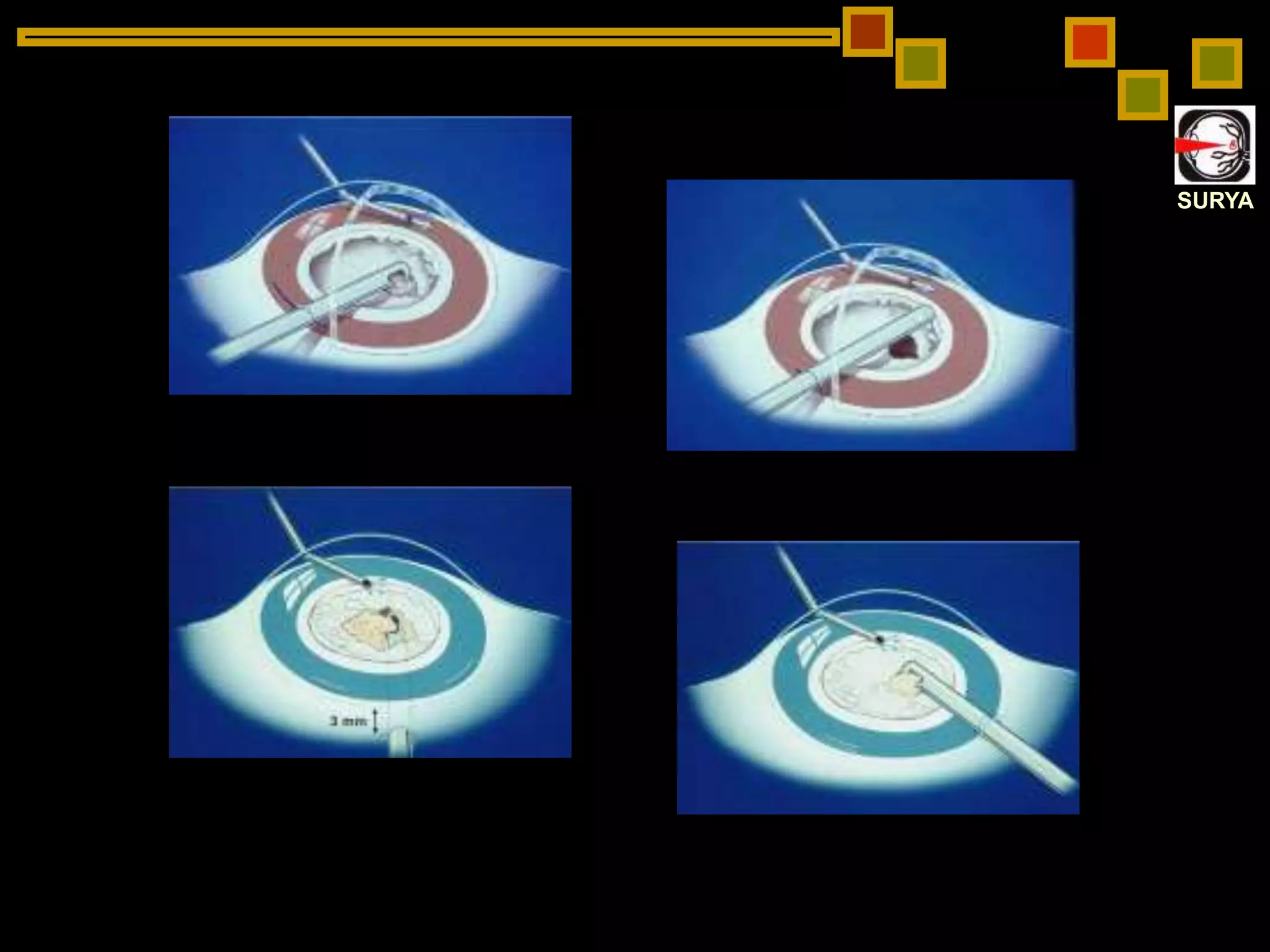 Core anterior vitrectomy DR AJAY DUDANI | PPT | Eye and Vision ...