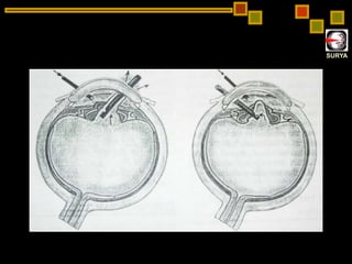 Core anterior vitrectomy DR AJAY DUDANI | PPT | Eye and Vision ...