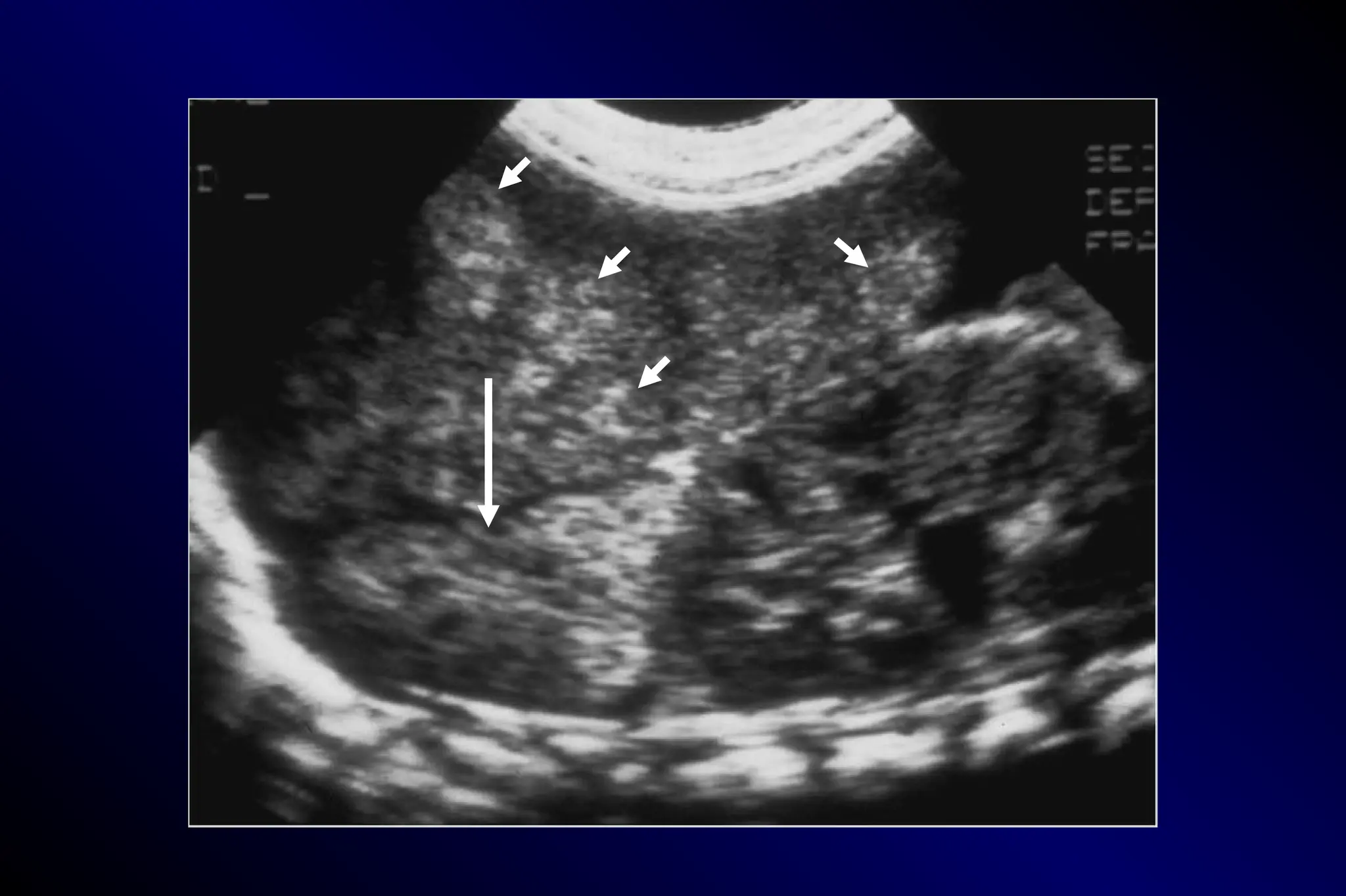 CORE CURRICULUM LECTURE 20 ADRENAL SONOGRAPHY .ppt