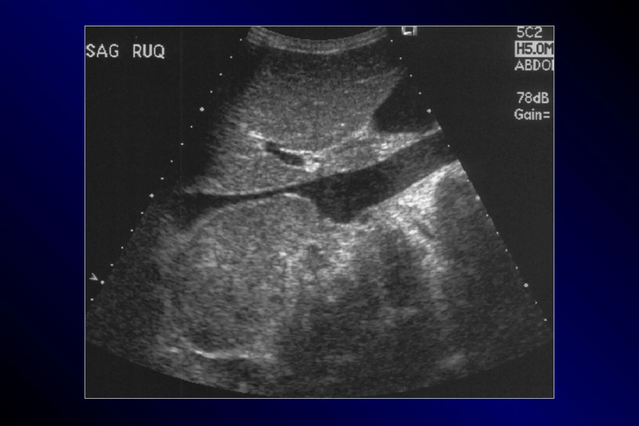 CORE CURRICULUM LECTURE 20 ADRENAL SONOGRAPHY .ppt