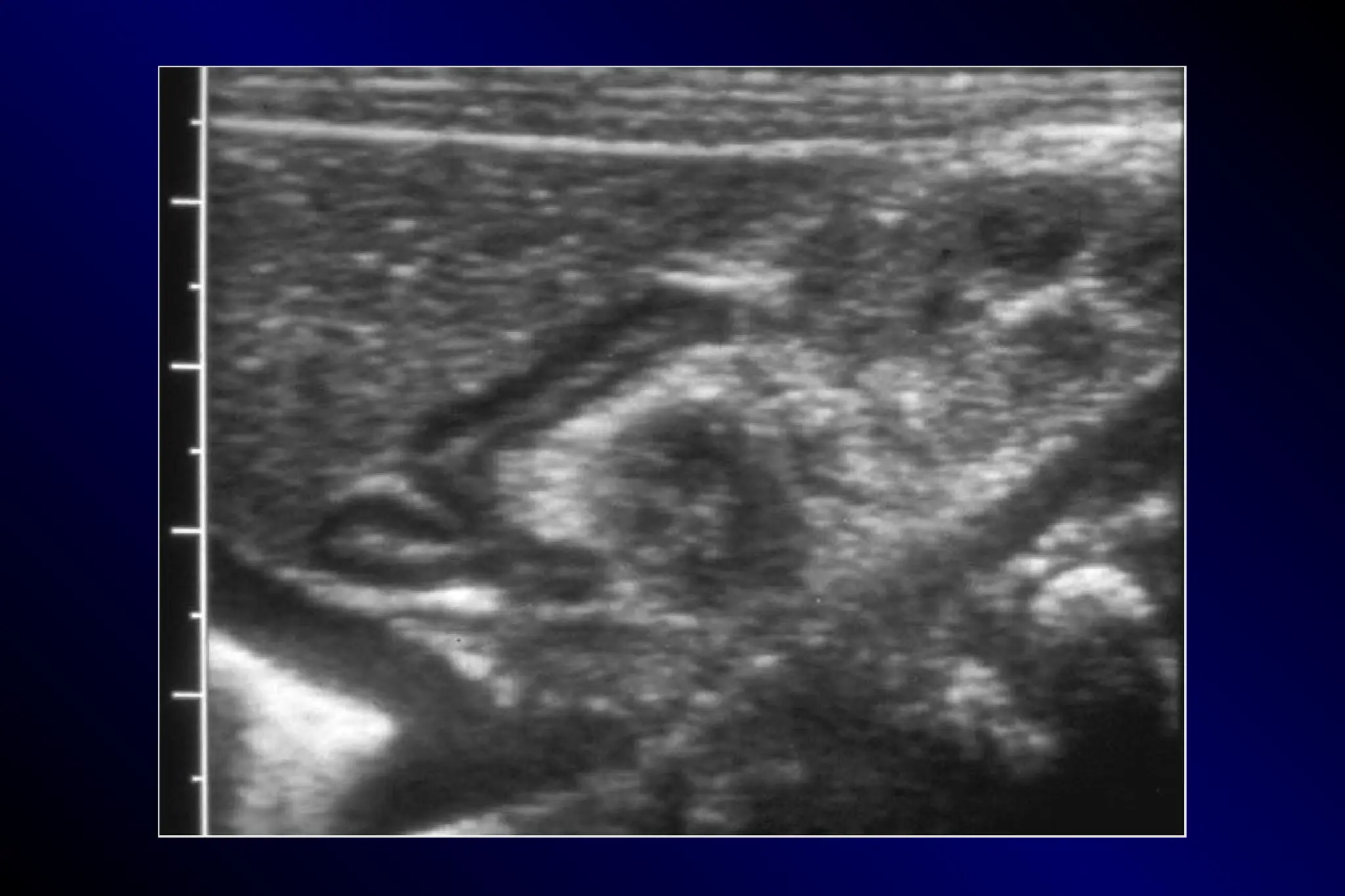 CORE CURRICULUM LECTURE 20 ADRENAL SONOGRAPHY .ppt