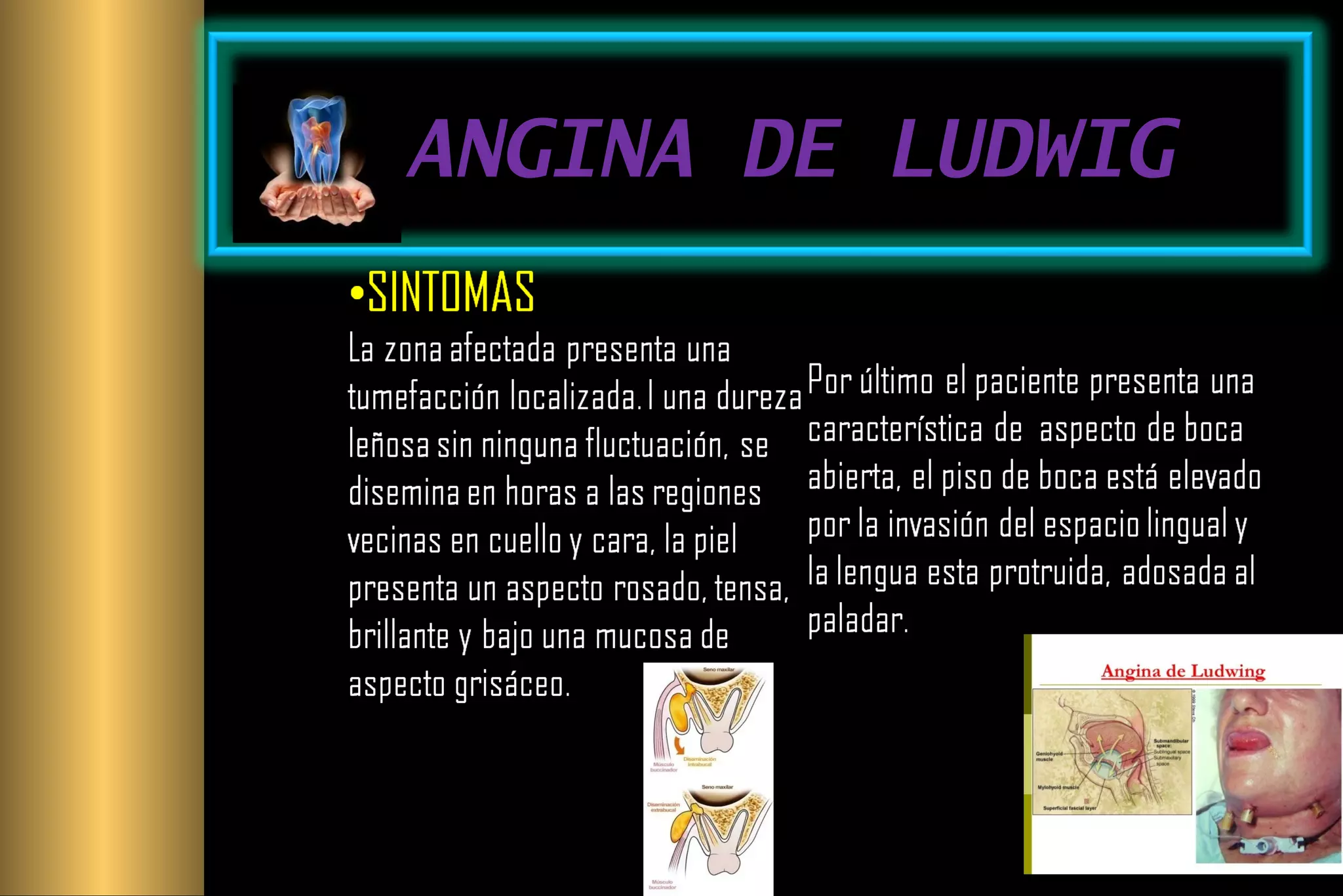 Angina de Ludwig Por: Corina Arias A. | PPT | Dental Health | Diseases ...