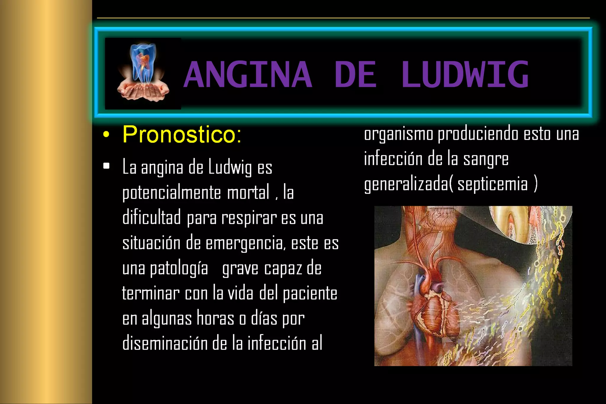 Angina de Ludwig Por: Corina Arias A. | PPT | Dental Health | Diseases ...