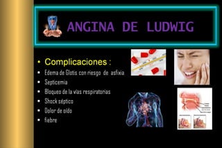 Angina de Ludwig Por: Corina Arias A. | PPT