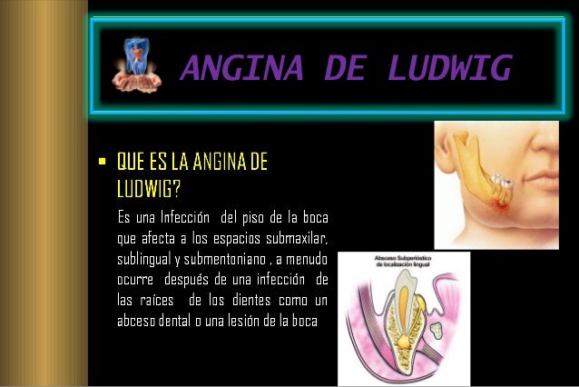 Angina de Ludwig Por: Corina Arias A.