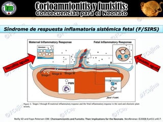 Corioamnionitis y funisitis. consecuencias para el neonato | PDF