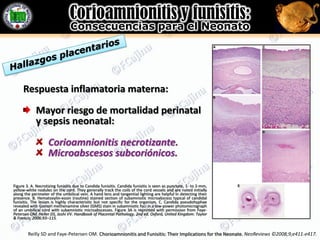 Corioamnionitis y funisitis. consecuencias para el neonato | PDF