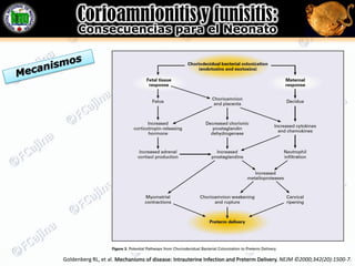 Corioamnionitis y funisitis. consecuencias para el neonato | PDF
