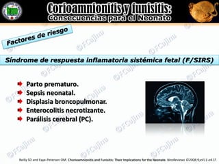 Corioamnionitis y funisitis. consecuencias para el neonato | PDF
