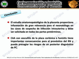 Corioamnionitis y funisitis. consecuencias para el neonato | PDF