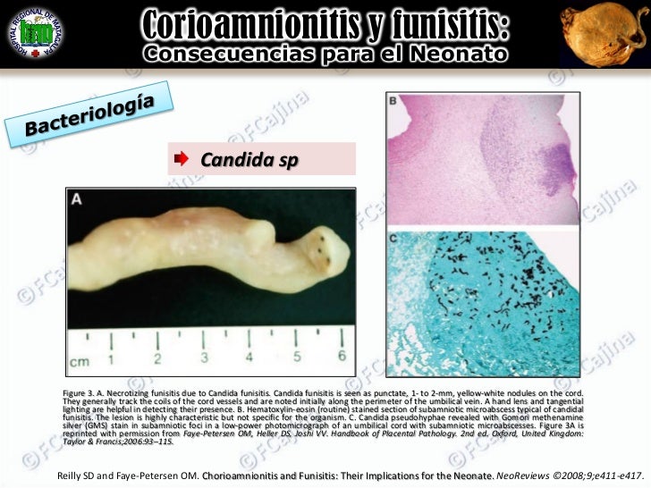 Corioamnionitis y funisitis. consecuencias para el neonato