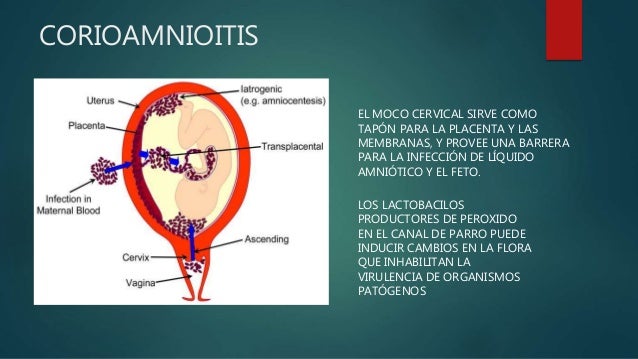 Corioamnioitis