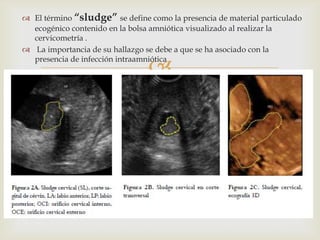 Corioamnionitis | PPTX