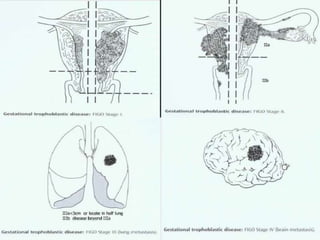 CORIOCARCINOMA ORIENTADO A LA PATOLOGIA.pptx