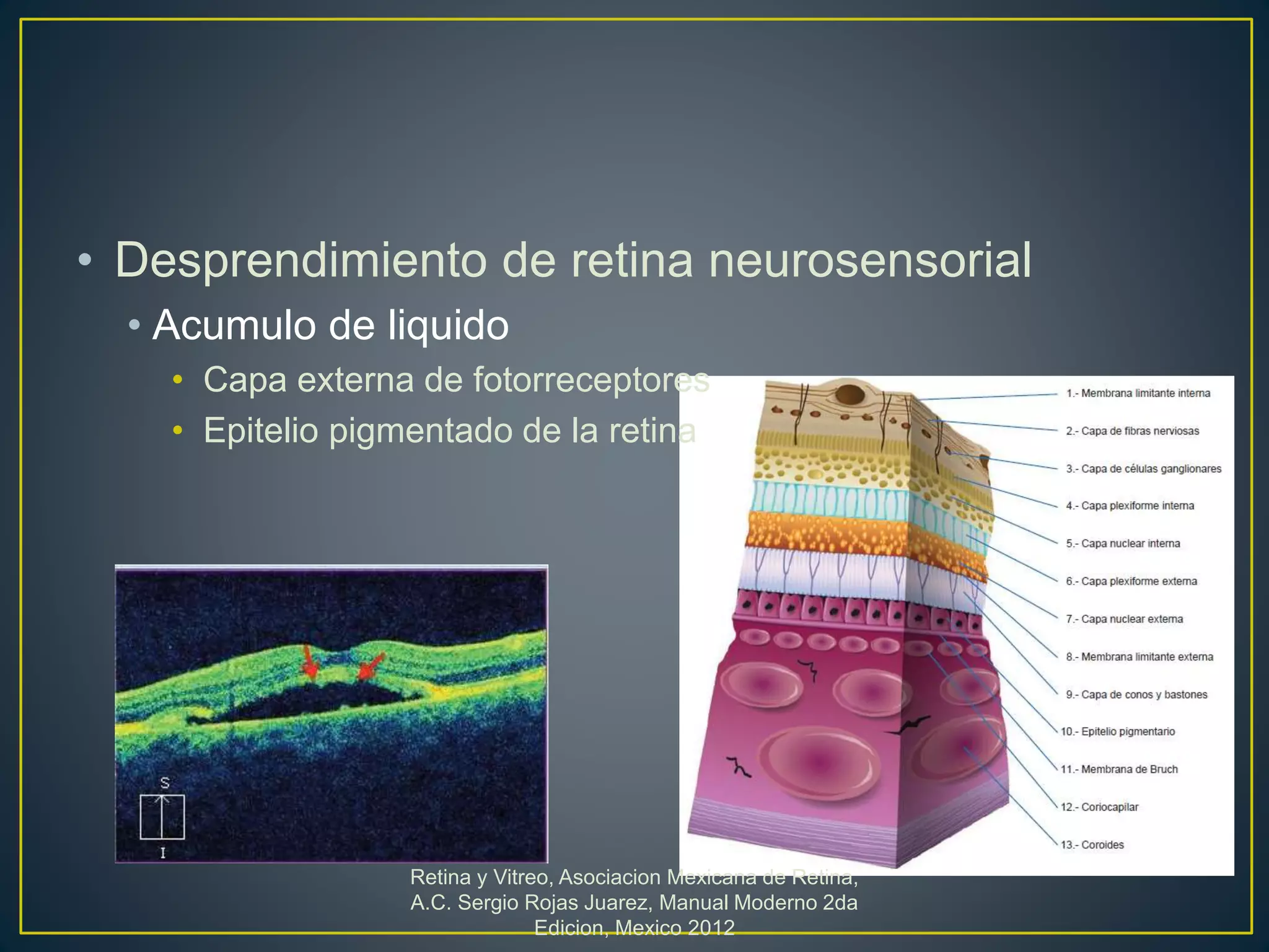 Coriorretinopatía serosa central | PPT