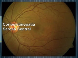 Coriorretinopatía serosa central | PPTX