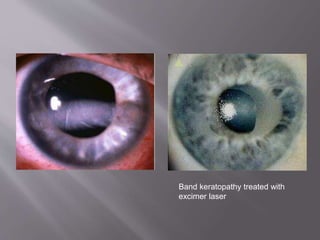 Early Band Keratopathy