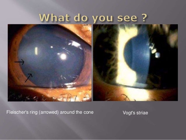 Common Cases: Cornea
